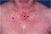 Blue Rubber Bleb Nevus Syndrome: Background, Pathophysiology, Etiology