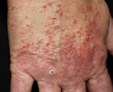 Multicentric Reticulohistiocytosis Clinical Presentation: History ...