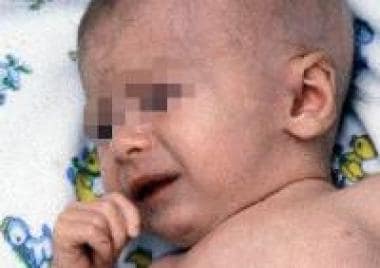 T-Cell Disorders Clinical Presentation: History, Physical, Causes