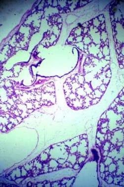 Pulmonary Interstitial Emphysema Workup: Approach Considerations ...