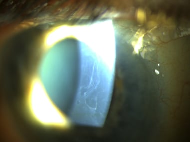 Epithelial Basement Membrane Degeneration Clinical Presentation ...