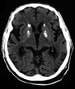 Alzheimer Disease Imaging: Practice Essentials, Computed Tomography, Magnetic Resonance Imaging