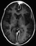 Subdural Empyema: Background, Pathophysiology, Etiology