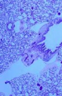 Pulmonary Interstitial Emphysema Workup: Approach Considerations ...