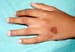 Syndactyly Clinical Presentation: History and Physical Examination ...
