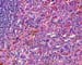 Inrebic (fedratinib) dosing, indications, interactions, adverse effects ...