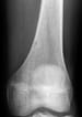 Fibrous Cortical Defect and Nonossifying Fibroma Imaging: Practice ...