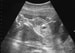 Congenital Cystic Adenomatoid Malformation (CCAM)/Pulmonary Airway ...