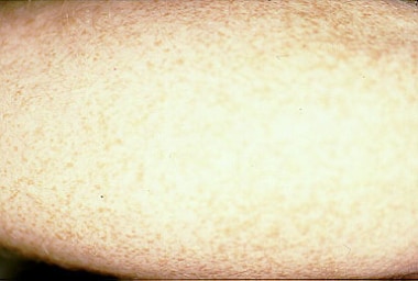 Lentigo Clinical Presentation: History, Physical Examination