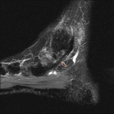 Tibialis Posterior Tendon Mri Foot And Ankle Problems By Dr. Richard