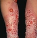 Bullous Pemphigoid: Background, Pathophysiology, Epidemiology