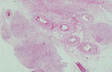 Dermatologic Manifestations of Neurilemmoma (Schwannoma) Workup ...