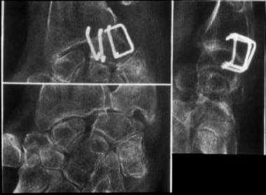 Wrist Arthritis Treatment & Management: Approach Considerations ...