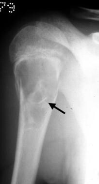 Simple Bone Cyst Imaging: Overview, Radiography, Computed Tomography