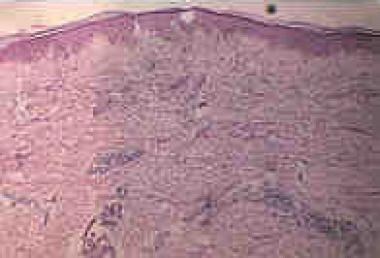Polymorphous Light Eruption Treatment & Management: Medical Care