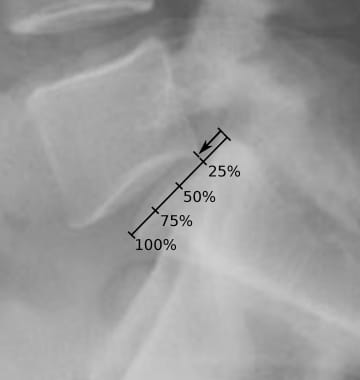 Spondylolisthesis, Spondylolysis, and Spondylosis Workup: Laboratory ...