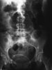 Postoperative Ileus