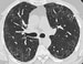 Idiopathic Pulmonary Fibrosis (IPF): Background, Pathophysiology, Etiology