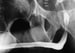 Urethral Trauma Imaging: Practice Essentials, Radiography, Computed ...