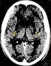 Wilson Disease