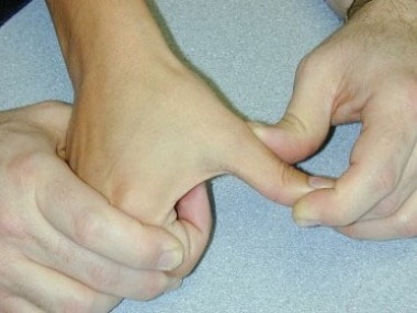 Skier's Thumb Clinical Presentation: History, Physical Examination