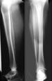 Acute Pyogenic Osteomyelitis Imaging: Practice Essentials, Radiography ...