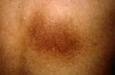 Macular Amyloidosis Clinical Presentation: History, Physical, Causes