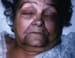 Alimta, Pemfexy (pemetrexed) dosing, indications, interactions, adverse ...