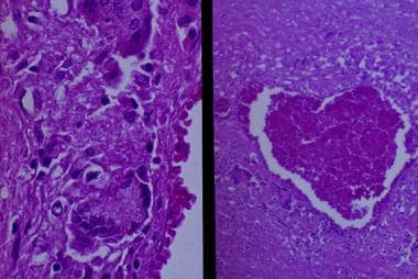 Aortitis Workup: Laboratory Studies, Imaging Studies, Histologic Findings