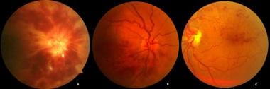 Retinal Vein Occlusion (RVO) Clinical Presentation: History, Physical ...