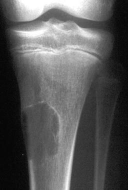 Simple Bone Cyst Imaging: Overview, Radiography, Computed Tomography