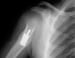 'Light Bulb Sign' in Posterior Shoulder Dislocation