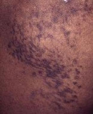 Pediatric Tinea Versicolor Differential Diagnoses