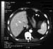 Splenic Abscess Treatment & Management: Approach Considerations ...