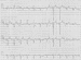 Pediatric Third-Degree Acquired Atrioventricular Block: Background ...