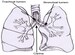 Right Middle Lobe Syndrome: Background, Pathophysiology, Epidemiology