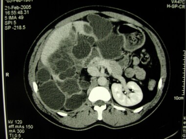 Echinococcosis Ct CMDT Media Library | AccessMedicine | McGraw Hill
