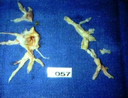 Pulmonary Embolism: Clot in Transit