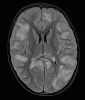 Acute Disseminated Encephalomyelitis Workup: Laboratory Studies ...