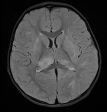 Acute Disseminated Encephalomyelitis Workup: Laboratory Studies ...