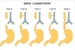 Esophageal Atresia (EA) and Tracheoesophageal Fistula (TEF) Imaging and ...