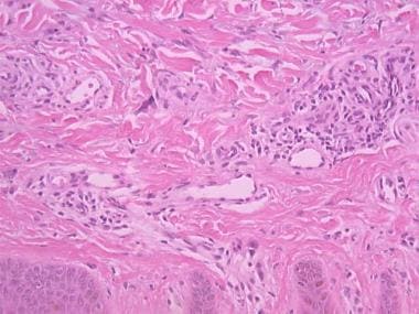 Multinucleate Cell Angiohistiocytoma Workup: Procedures, Histologic ...