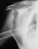 Imaging in Neuropathic Arthropathy (Charcot Joint): Practice Essentials ...