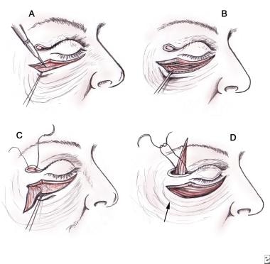 Lower Lid Subciliary Blepharoplasty Treatment & Management ...
