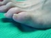 Fifth-Toe Deformities