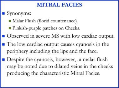 Malar Flush Mitral Stenosis
