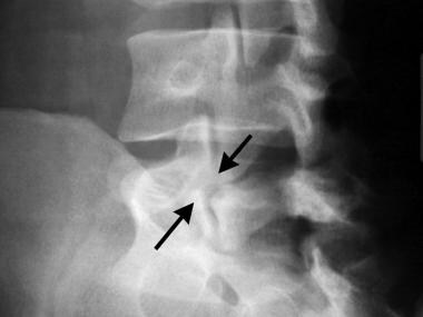 Spondylolisthesis Imaging: Overview, Radiography, Computed Tomography