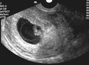 Subchorionic Hemorrhage Imaging: Overview, Computed Tomography ...