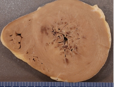 Acute Myocardial Infarction Pathology: Overview, Pathophysiology, Etiology
