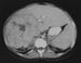 Hepatocellular Carcinoma (HCC) Workup: Approach Considerations ...